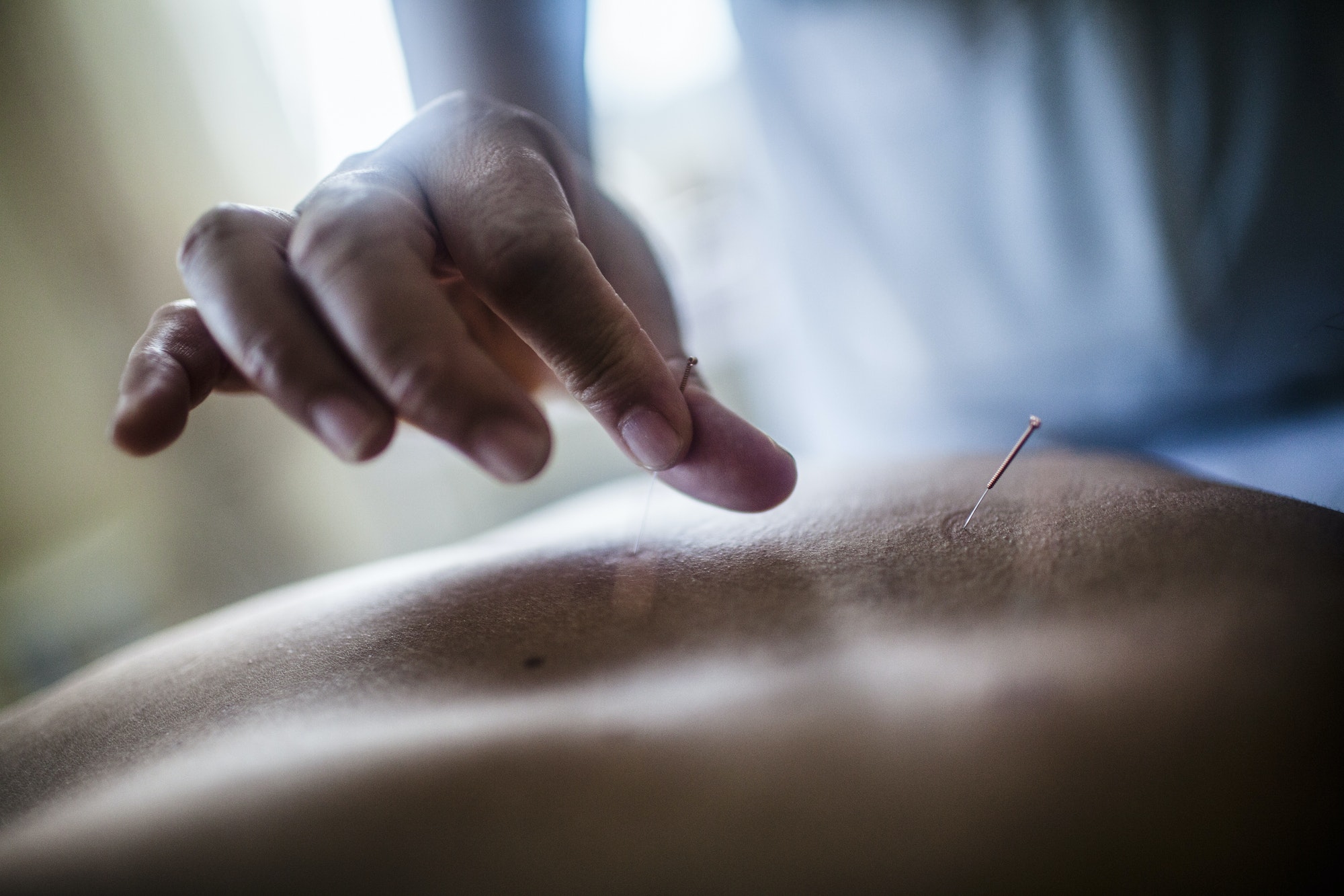 L'acupuncture : une ancienne technique de relaxation revisitée